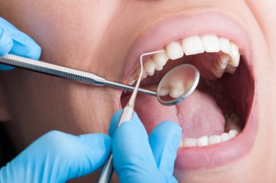 Plaque Vs. Tartar | Dentist Leesburg | Dr. Eddie C. Orobitg